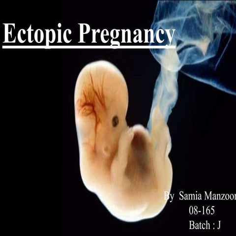 Ectopic | PPTX