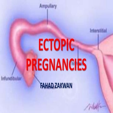 ECTOPIC PREGNANCY | PPTX