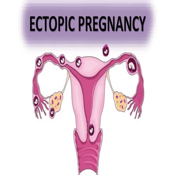 ectopic pregnancy.pptx