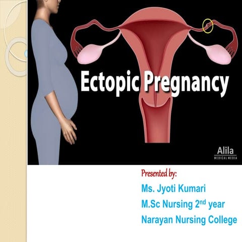 ectopic pregnancy.pptx