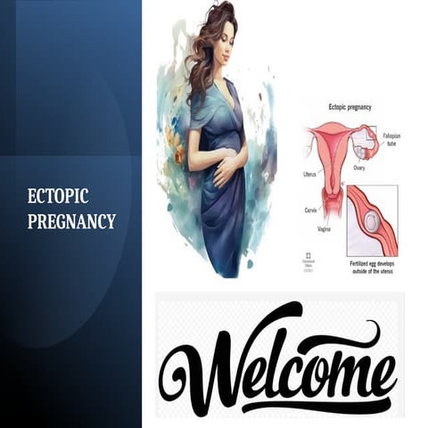 ECTOPIC PREGNANCY.pptxhsjdhsjjdhdjdndndndjdnd | PPTX