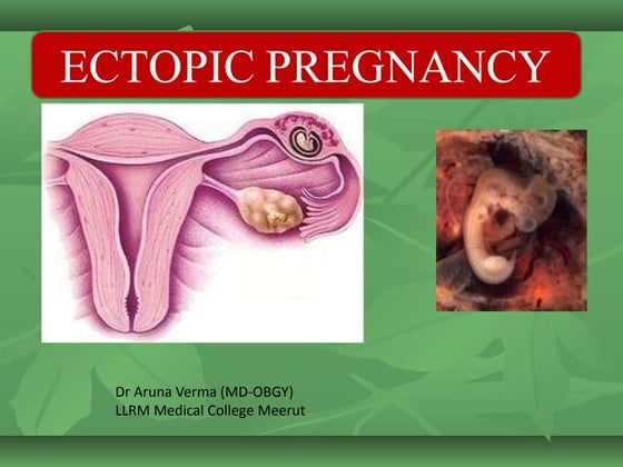 Ectopic Pregnancy | PPTX | Infertility | Reproductive Health