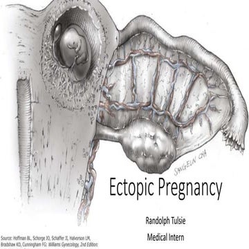 Ectopic Pregnancy | PPTX