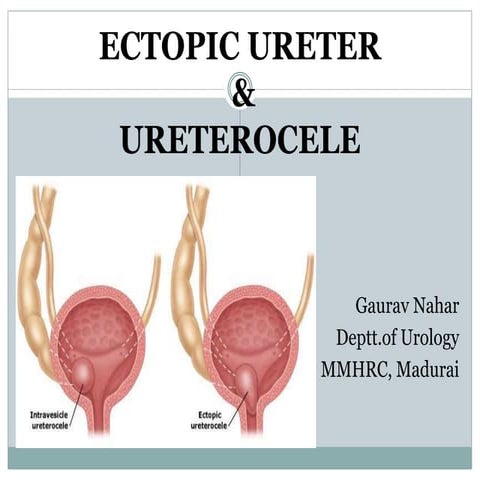Ectopic ureter & ureterocoele | PPTX