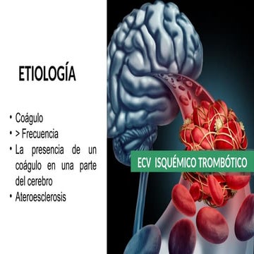 ECV, evento cerebro vascular .eliza.pptx