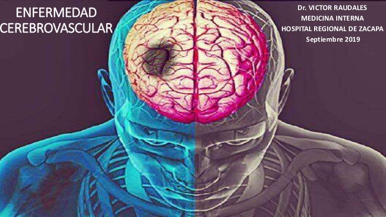 ECV Isquemico. Dr Victor Raudales. Médico Internista