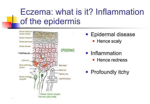 Eczema | PPTX