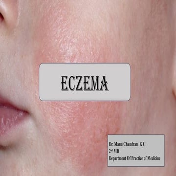 eczema.pptxnnnnnnnnnnnnnnnnnnnnnnnnnnnnnnn | PPTX