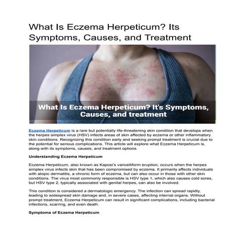 What Is Eczema Herpeticum? Its Symptoms, Causes, and Treatment | PDF