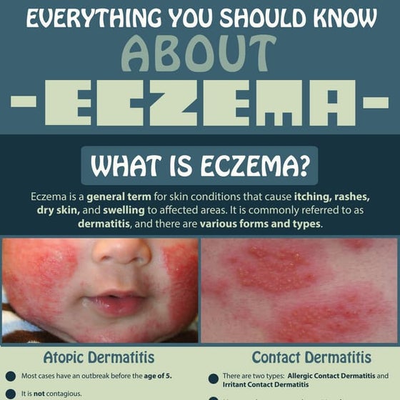 What Is Eczema? | PDF