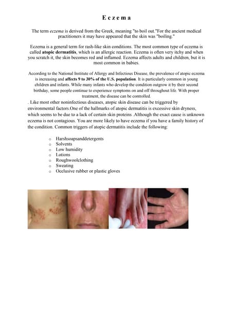 Eczema Powerpoint | PPT