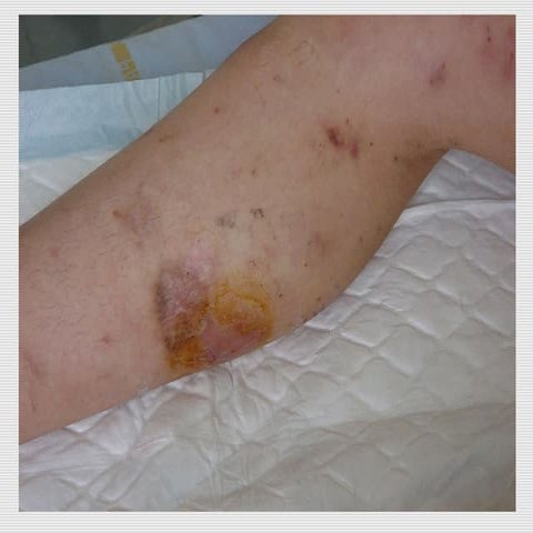 Edel injection (partie 2.1) | PPT