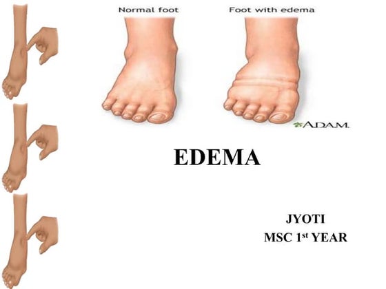 Pathophysiology of edema | PPT