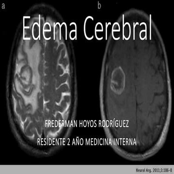 Edema cerebral | PPTX