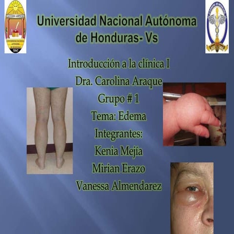 Escala edema | PDF