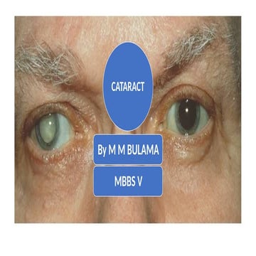 CATARACT made easy and in great detail.pptx