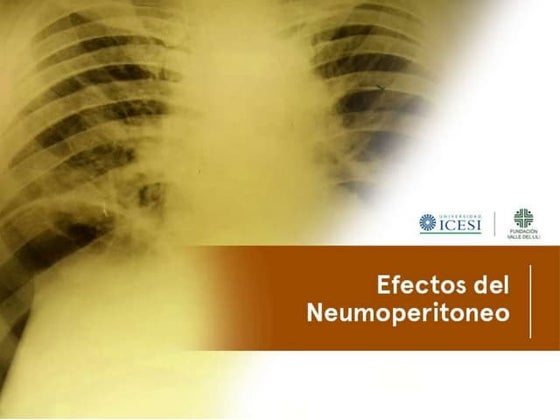 Signos Radiologicos Del Neumoperitoneo
