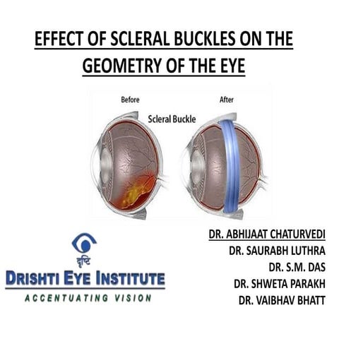 Effect of scleral buckle on geometry of eye.pptx