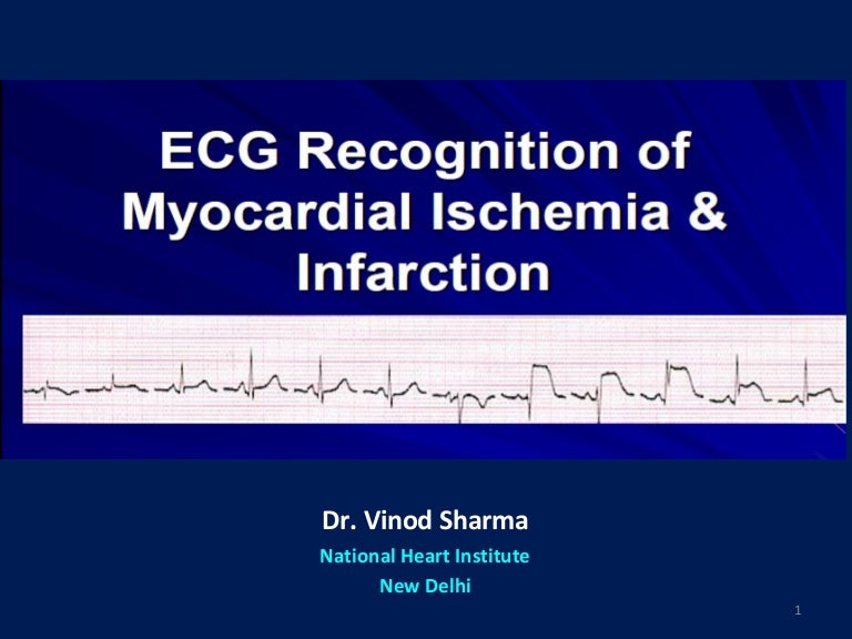 Ekg myocardial ischemia & Infarction