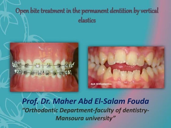 TREATMENT OF OPEN BITE with use of orthodontic appliances | PPT