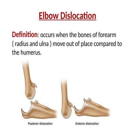 Elbow Dislocation - Anatomy WPS Office.pptx