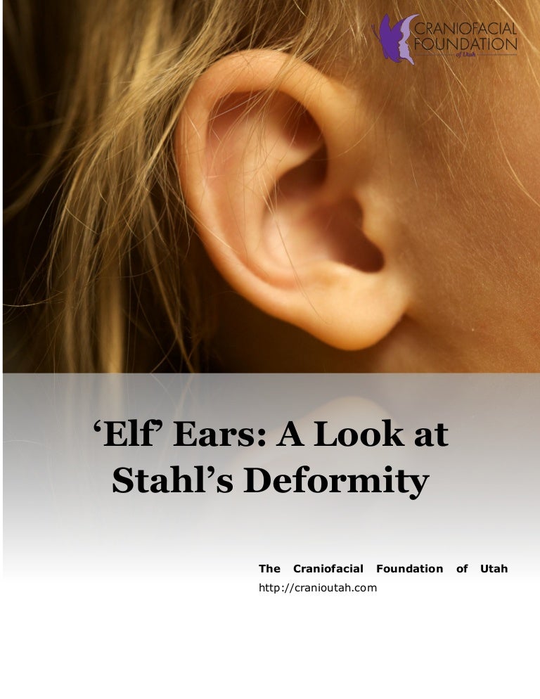 ‘Elf’ Ears: A Look at Stahl’s Deformity