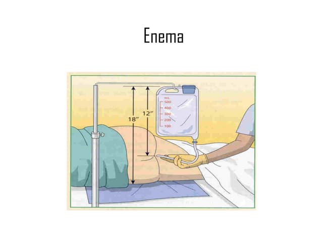 Enema | PPTX