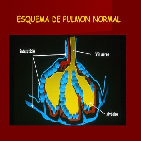 El intersticio pulmonar Dr Alejandro Abritta UBA | PPT