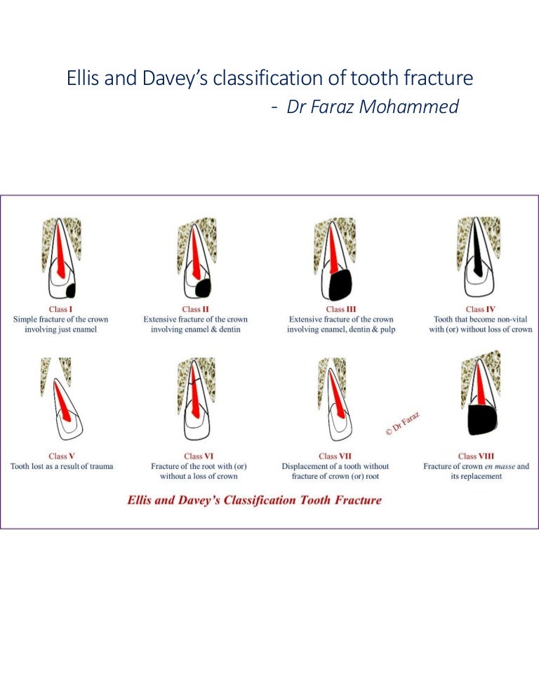 Ellis and davey’s classification of tooth fracture