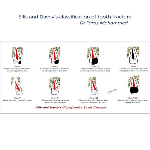 Ellis and davey’s classification of tooth fracture | PDF