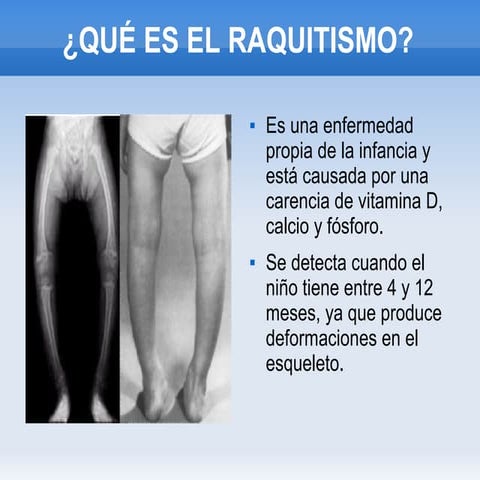 Qué es el raquitismo