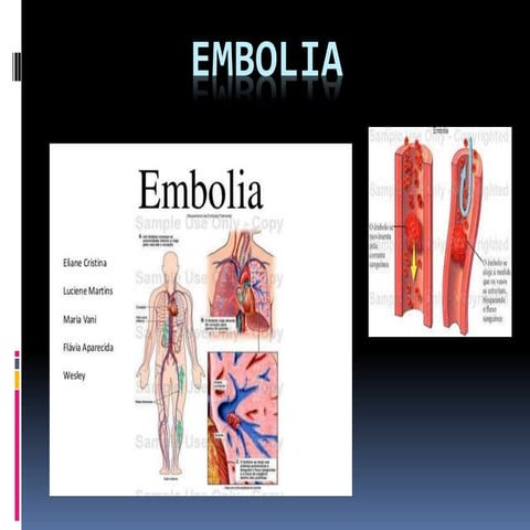 Embolia | PPTX