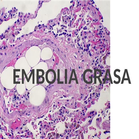 Embolia Grasa en Pacientes con traumatismo | PPTX