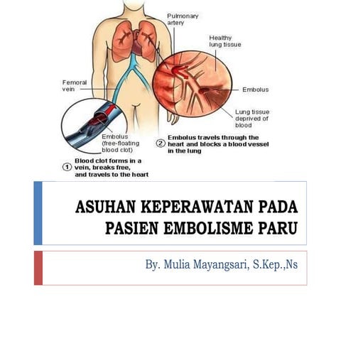 Embolisme paru | PPT