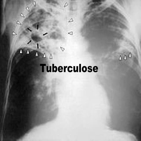 Tuberculose | PPTX