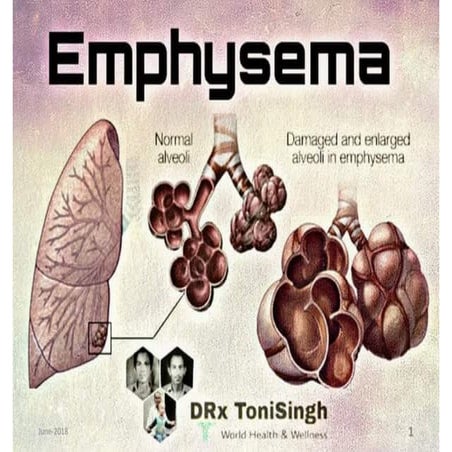 Emphysema | PDF