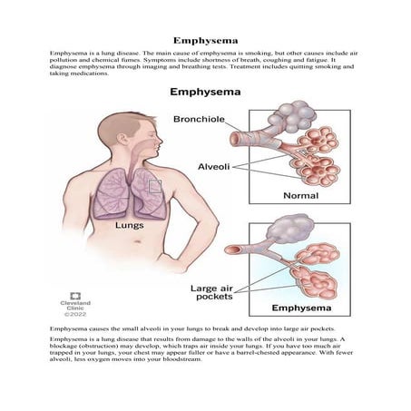 Emphysema.docx of general medicine subject | DOCX