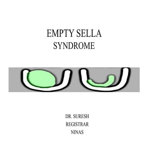 Empty sella syndrome | PPTX | Bone and Joint Conditions | Diseases and ...