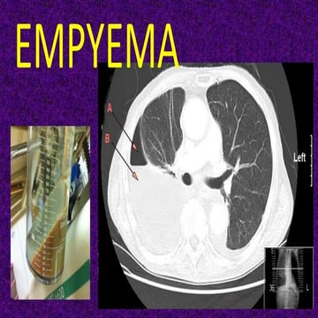 Empyema | PPTX