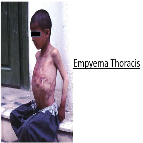 Empyema .ppt