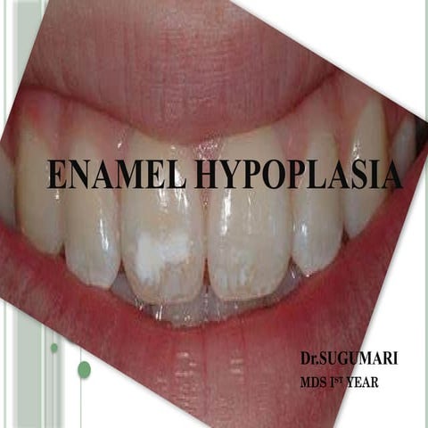 enamel hypoplasia-1.pptx for enamel hypoplasia | PPTX