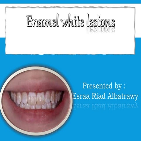 Incipient caries | PPTX