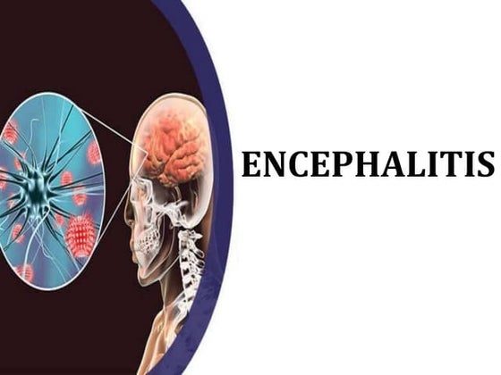 Encephalitis | PPT