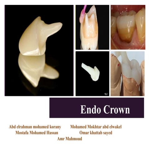 Endo crown | PPTX