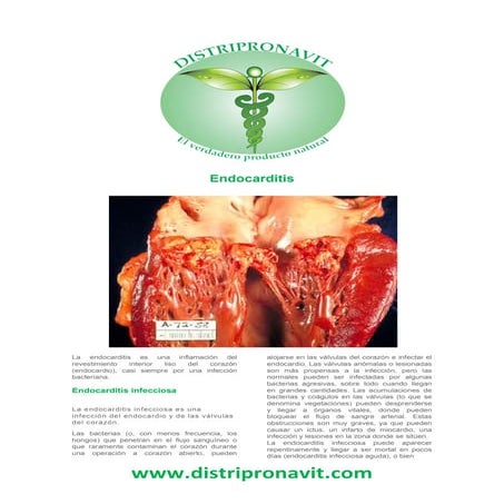 Endocarditis bacteriana | PPTX