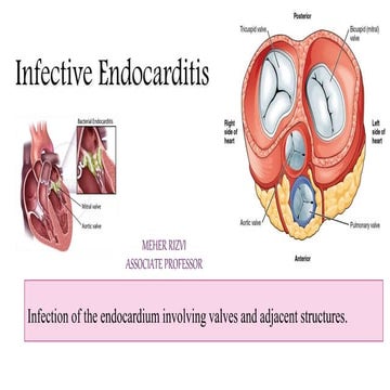 Endocarditis april 2018 | PPT