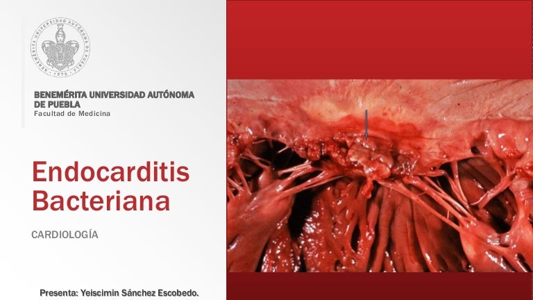 Endocarditis Bacteriana Cardiologia
