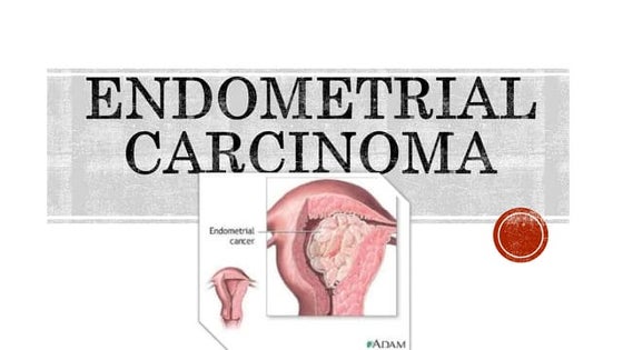 Endometrial Carcinoma | PPT