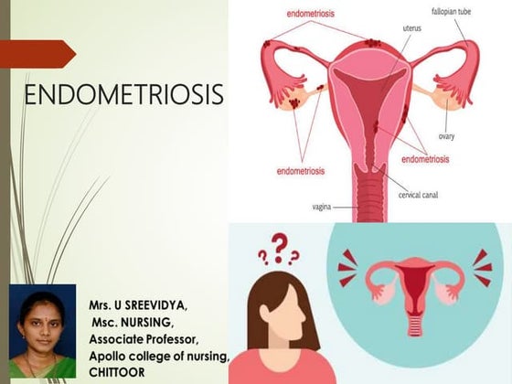 Endometriosis- Easy explanation with Management... | PPT