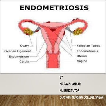 endometriosis.pdf